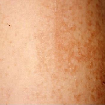 Macular Rash