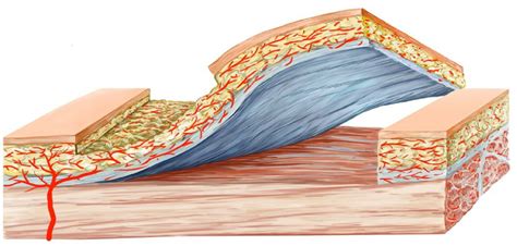Superficial Muscular Aponeurotic System Pedicled Flaps For The
