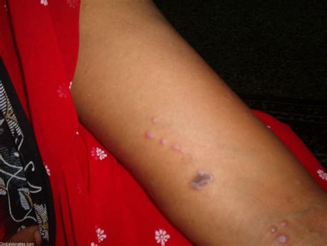 30 Eye Opening Pictures Of Lichenoid Dermatitis