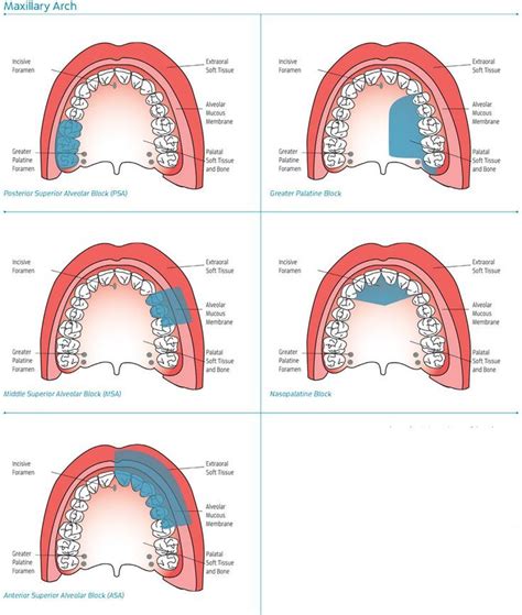 Dental Nerve Block Anesthesia At Lorraine Mathes Blog