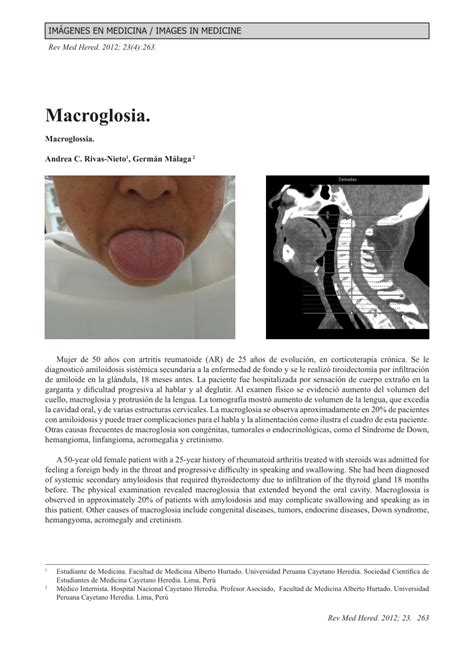 Pdf Macroglossia