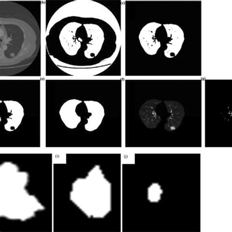 classification and diagnosis results of preliminary segmentation a ct