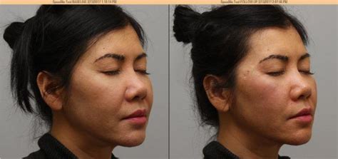 Pdo Threads Expertise Lumier Medical