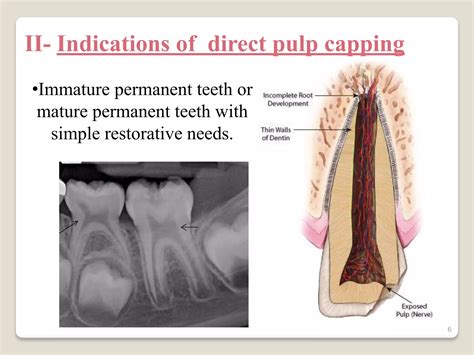 Direct Pulp Capping Pdf