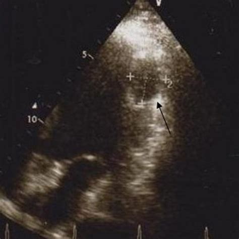 Tte In Three Chamber View Shows Apical Cyst Black Arrow Download