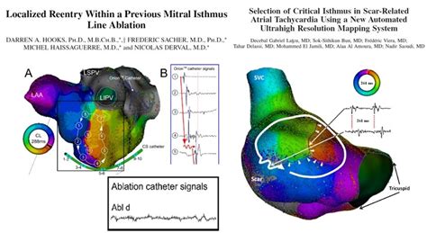 Rhythmia Hdx Evidenze Cliniche Nel Flutter Atipico Aiac