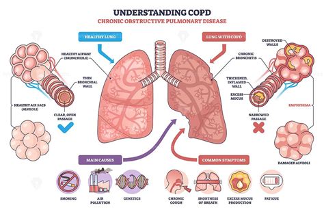 Understanding Copd Brief Visual Contrasts Healthy Lung With Copd Lung Showing Bronchi Mucus