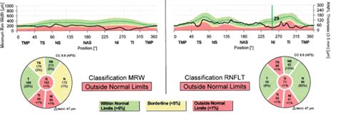 Using Erg To Monitor Glaucoma Lkc Technologies