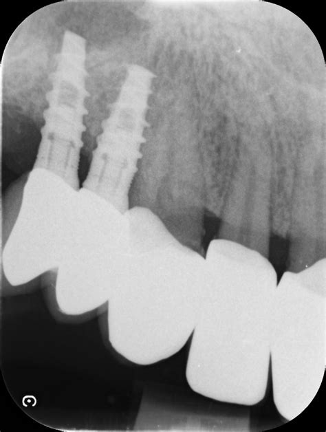 Zirconia Crowns Cementation With Resin Modified Glass Ionomer Cement Myzerodonto