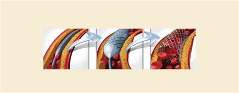 Angiogram Vs Angiography Vs Angioplasty Whats The Difference Knya