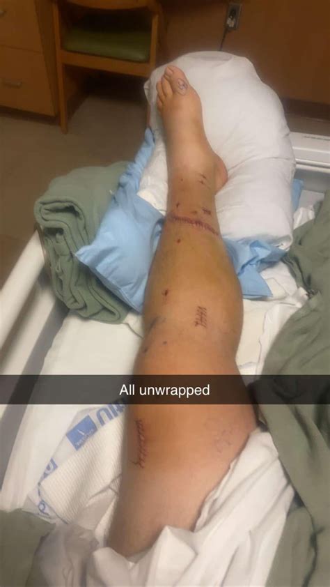 Open Tib Fib Fracture