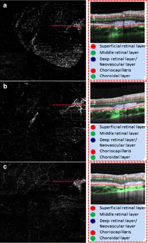 Oct At The Level Of The Choroidal Rupture With Concern For Cnvm Shown