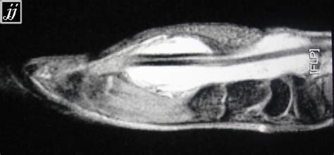 Msk Ganglion Cyst Around Flexor Tendon Hand Sagittal Radioogle
