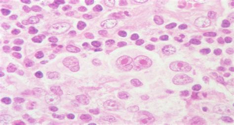 Lymphoma Flashcards Memorang