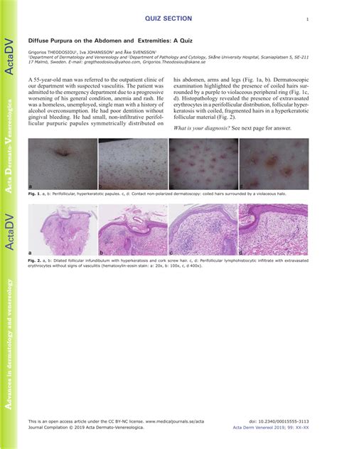 PDF Diffuse Purpura On The Abdomen And Extremities A Quiz