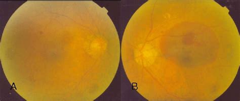 Fundus Photographs A Normal Fundus B Subretinal Hemorrhage Download Scientific Diagram