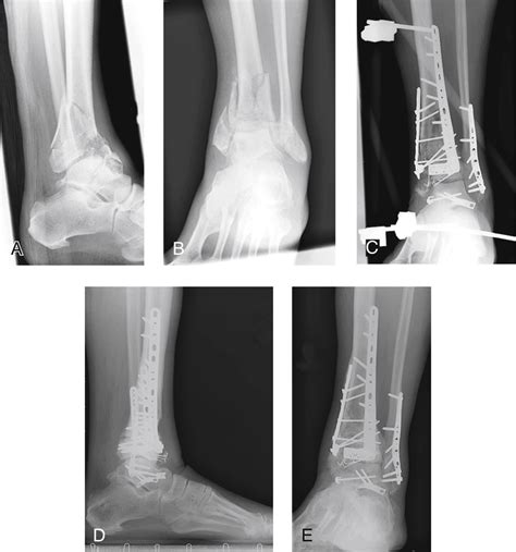 Open Reduction And Internal Fixation Of The Tibial Plafond Musculoskeletal Key