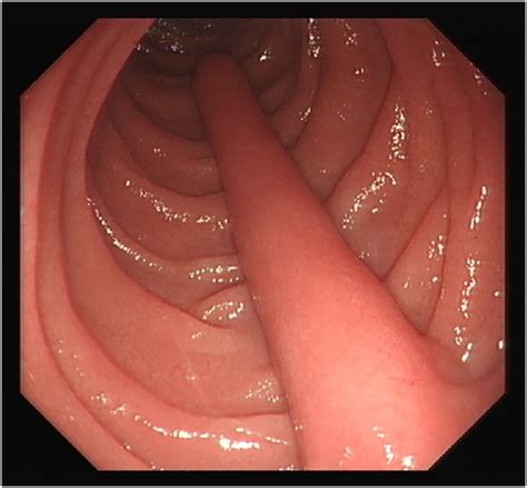 Muco‐submucosal Elongated Polyp Of The Git Under White Light Download Scientific Diagram