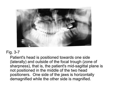 Positioning Errors In Panoramic Radiography Ppt