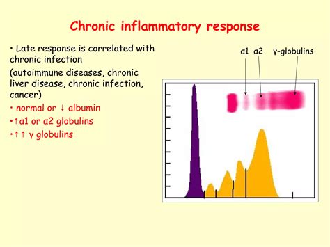 Interpreting Serum Protein Electrophoresis Ppt