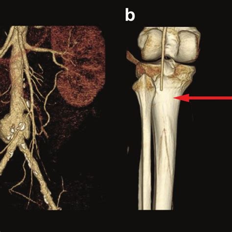 A A Volume Rendered Three Dimensional Computed Tomography Ct Download Scientific Diagram