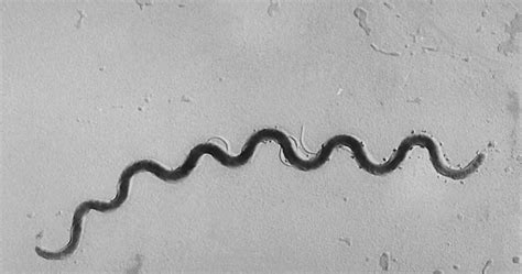 Syphilis Stages Signs Symptoms Diagnosis Treatment And Syphilis Cure
