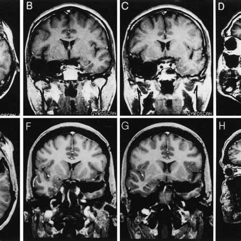 Resection Of Anterior Insular Cortex In The Outlier Left Coronal