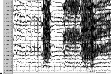 Focal Motor Seizures Neupsy Key