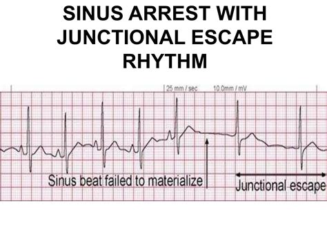 Atrial Flutter And Bradycardias Pptx