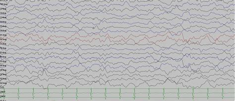 癫痫患者为什么需要做脑电图？ 知乎