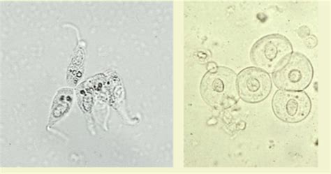 Transitional Renal Epithelial Cells In Urine