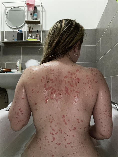 Best R Psoriasis Images On Pholder The Worst Case Of Psoriasis My Doctor Has Ever Seen Update