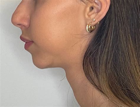 Condylectomy Surgery Dr Waseem Abboud