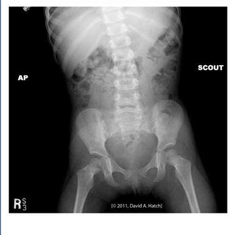 Voiding Cystourethrogram Flashcards Quizlet