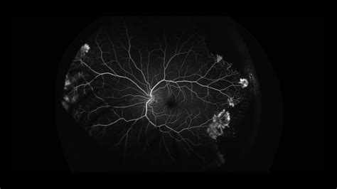 Vitrectomy For Sickle Cell Retinopathy Youtube