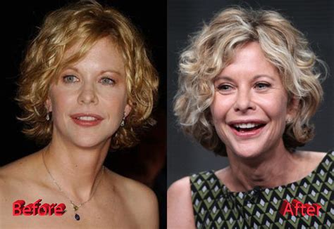 Meg Ryan S Dramatic Transformation The Untold Story Behind Her Plastic Surgery Rumors Plastic
