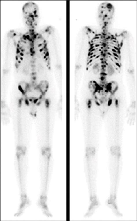 Prostate Cancer Urology News