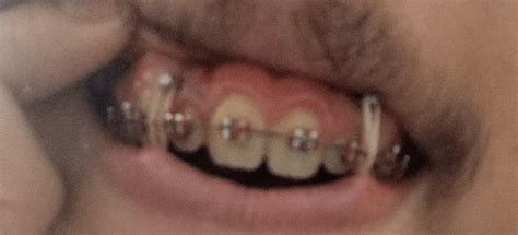 Is This Normal R Braces