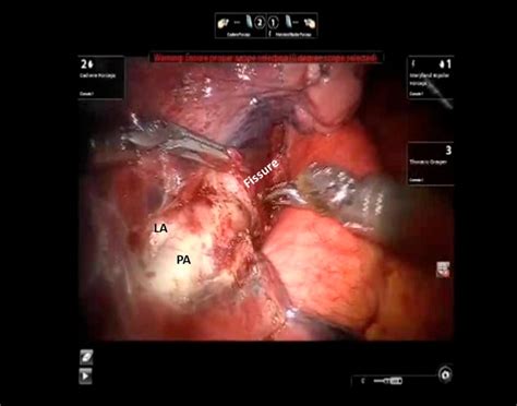 The Technique Of Robotic Anatomic Pulmonary Segmentectomy Ii Left Sided Segments