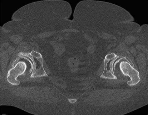Sequence Of The Computed Tomography Of The Pelvis Which Shows The