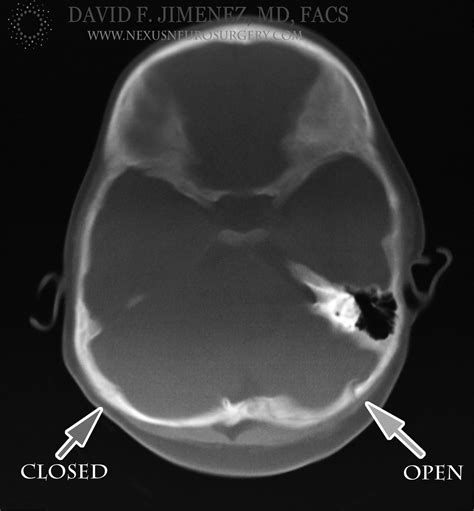Lambdoid Synostosis Facts And Photos David F Jimenez Md
