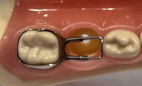 Tallahassee Restorative Dentist Tiny Teeth Of Tally