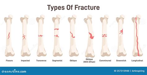 Degrees Of Bone Fractures At Dennis Raleigh Blog
