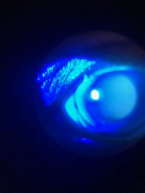 Fingernail Scratch Ophthalogix