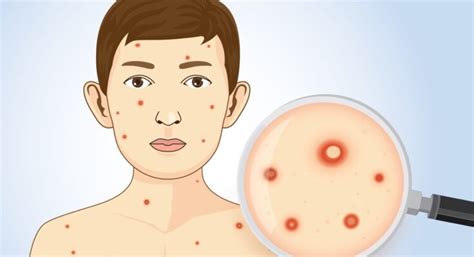 Chickenpox Diagnosis And Treatment Chickenpox Diagnosis And Treatment