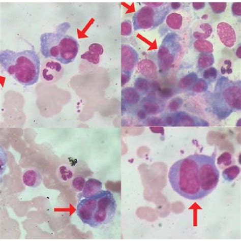 Plasma Cell Morphology In Bone Marrow Smears After Treatment Download Scientific Diagram