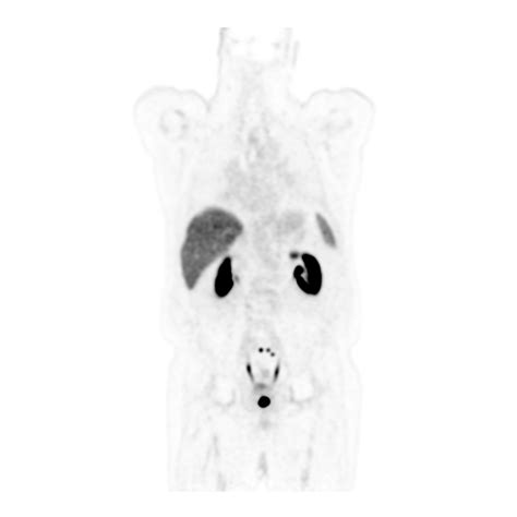 Body Cartesion Prime Clinical Gallery Molecular Imaging Canon Medical Systems Usa