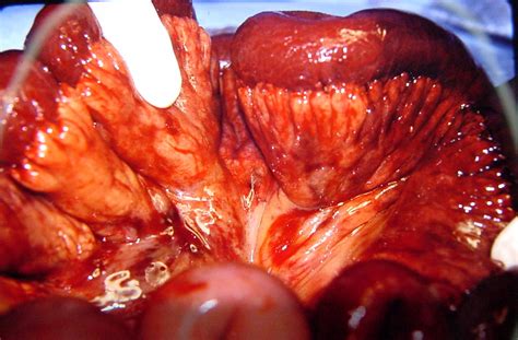 Mesenteric Venous Thrombosis Surgery Photos