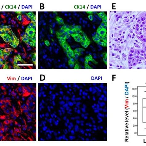 Vim Expression In Ck14 Positive Cancer Cells A Multiple