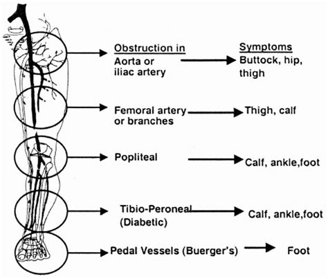 Approach To Claudication Thoracic Key